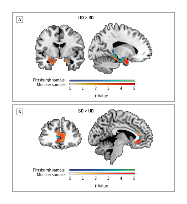 Brain Morphometry Separates Bipolar vs Unipolar - Gateway Psychiatric