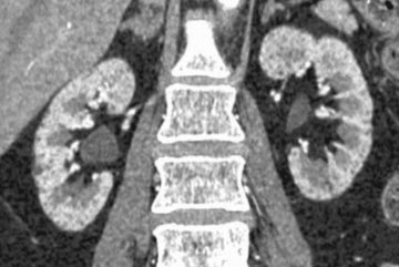 Lithium and Kidney Damage - Gateway Psychiatric