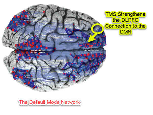 Default Mode Network and Depression Treatment - Ketamine and TMS ...