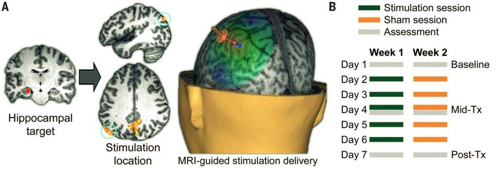 TMS Improves Memory - Gateway Psychiatric